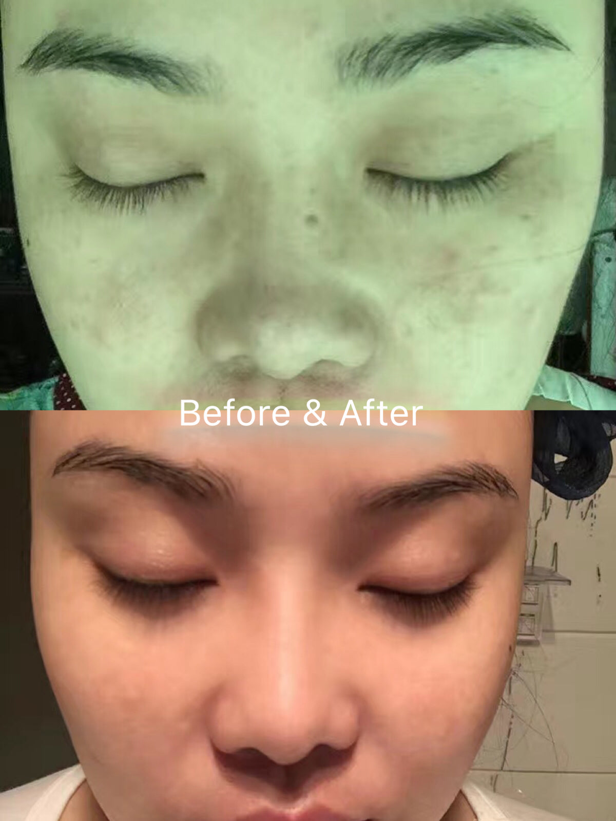 Bio Needle 120 Adjustable Needle Size Derma Stamp – Nasvita Medical