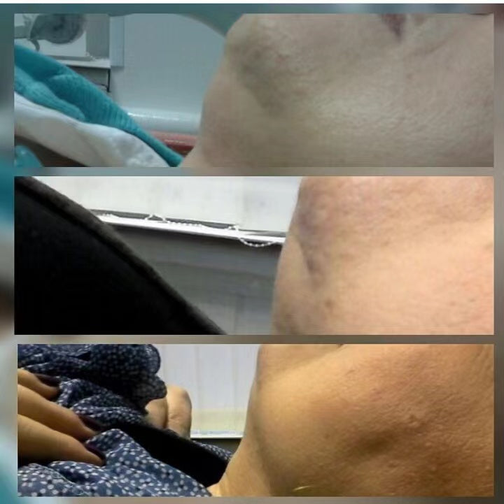 Bio Needle 120 Adjustable Needle Size Derma Stamp – Nasvita Medical